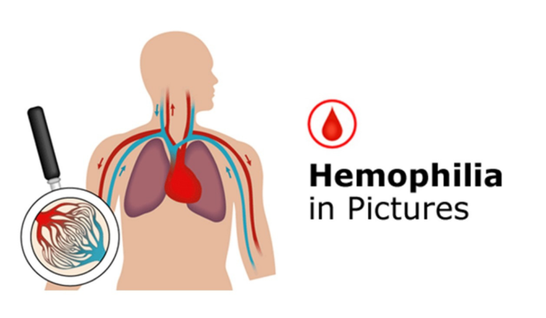 Education and eLearning – WFH - World Federation of Hemophilia